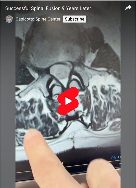 Successful Spinal Fusion 9 Years Later - William Capicotto, M.D. PC ...